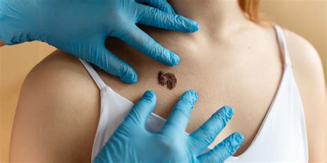 Merkel Cell Carcinoma Treatment Symptoms Causes And Diagnosis