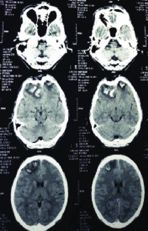 Ct Scan Shows Frontal Depressed Fracture With Hemorrhagic Contusion