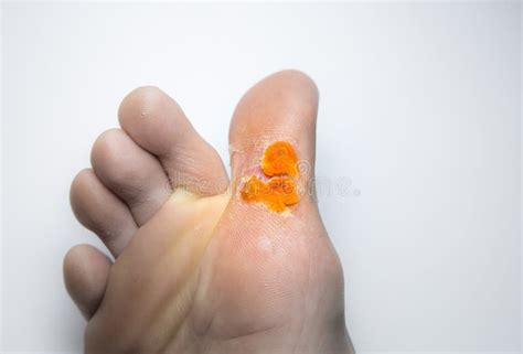 Contagious Skin Illness On Foot Medical Treatment Photoclose Up
