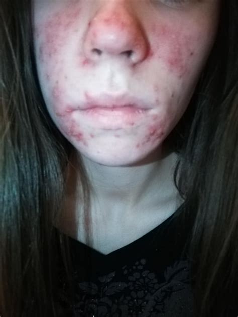 Before And After Doxycycline Treatment R Acne