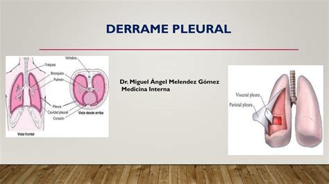 Derrame Pleural Birsabec Reyna Udocz