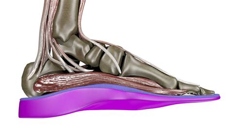 Orthotics For Bursitis Solescience