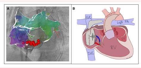Figure 5 From Ablation Of Atrial Flutter In A Patient After Fontan Procedure A Case Report Of