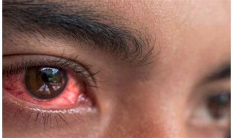 Alert Red Eyes Disease Breaks Out In Kampala Schools Ug Standard