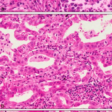 Histologic Features Of The Micropapillary Pattern In Pulmonary