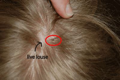 What Do Lice Look Like Pictures Of Nits Eggs And Lice