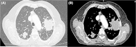 A Chest Ct Axial Cut Lung Window Multifocal Patchy Consolidation