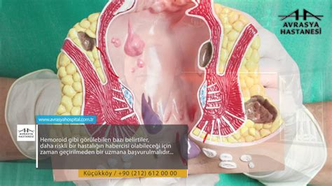Hemoroid Nedir YouTube