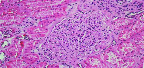 Moderate Increase In Mesangial Matrix And Cells In The Glomeruli