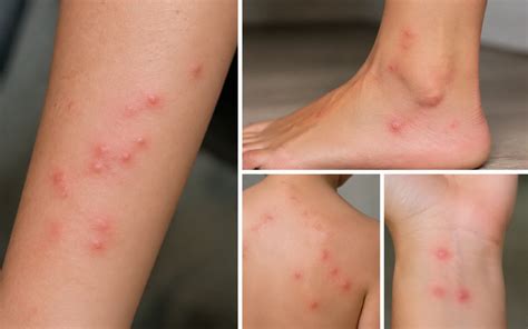 Cockroach Bites Vs Bed Bug Bites Spot Key Differences