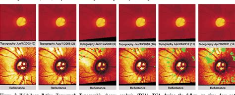 Figure 1 From Agreement In Identification Of Glaucomatous Progression Between The Optic Disc