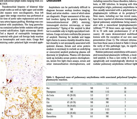 Immunohistochemistry For Kappa A And Lambda B Light Chains Reveals