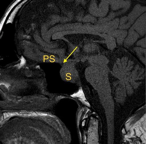 Preoperative Approach To Sellar Region Masses What The Surgeon Needs