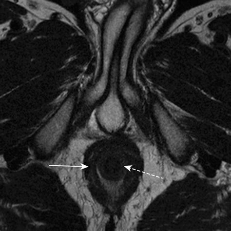 Anorectal Cancer Critical Anatomic And Staging Distinctions That