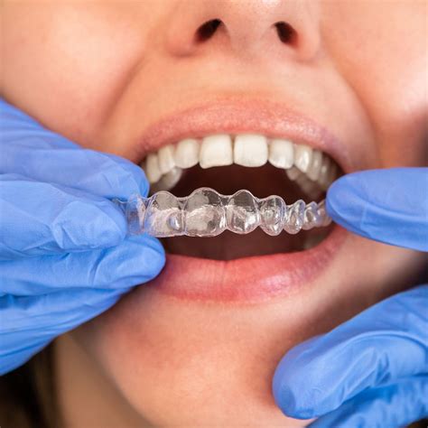 How To Find A Good Invisalign Dentist Near Me