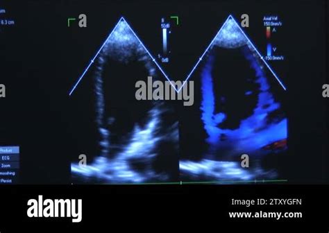 Cardiac Ultrasound Stock Videos And Footage Hd And 4k Video Clips Alamy