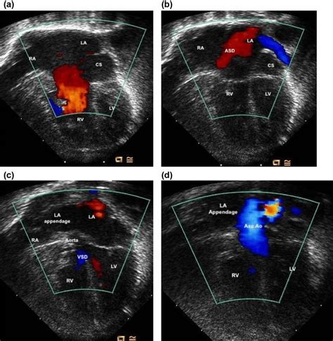 Ad Juxtaposition Of The Left Atrial Appendage To The Right Apical