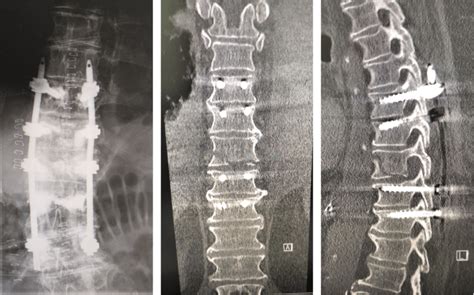 Distraction Fracture T8posterior Fixation T6 T10martin H Hessmann