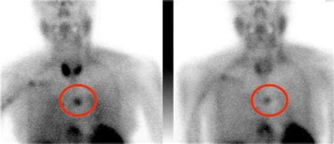 Parathyroid Ct Scan Versus Nuclear Medicine Scan Video Endocrine