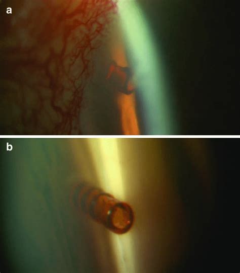 3 A Improperly Positioned Cypass Micro Stent Protruding Anteriorly