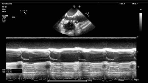 echocardiography tutorial echocardiographic modes