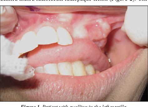 Figure 2 From Maxillary Osteosarcoma Two Case Reports And Literature