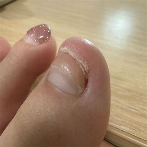 問題 指甲被肉擋住 🥺 美甲板 Dcard