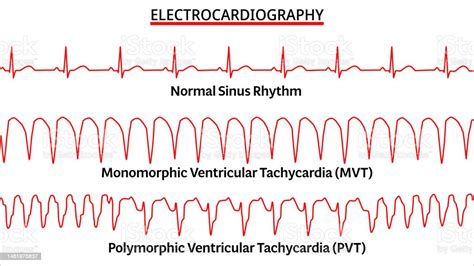 Ecgの一般的な異常のセット正常な洞リズム単形vt多型vt 頻脈のベクターアート素材や画像を多数ご用意 頻脈 心室 リズム