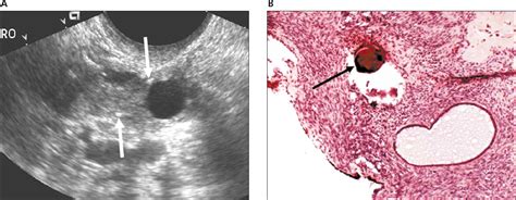 Small Echogenic Foci In The Ovaries Brown 2004 Journal Of