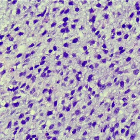 Histopathological Findings Of The Tumor Tumor Small Round Cells Having