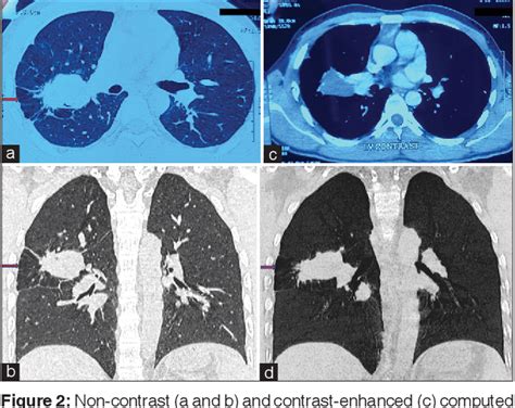 Figure 2 From Congenital Bronchial Atresia Presenting With Chronic