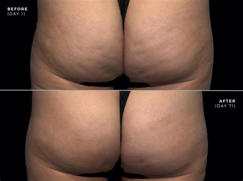 Skin Dimpling Of Hip