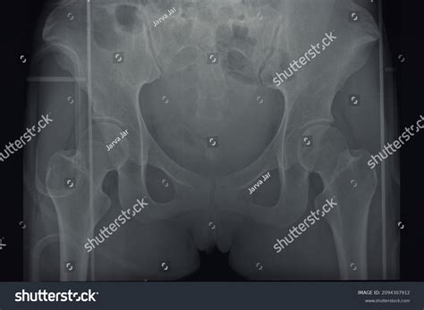 Xray Show Closed Fracture Pelvic Stock Photo Shutterstock
