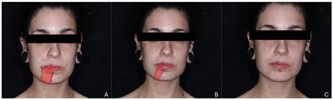 Health Related Quality Of Life With Iatrogenic Inferior Alveolar Nerve