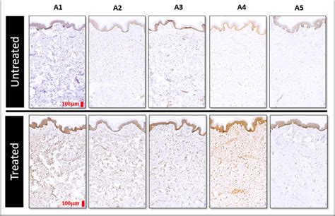 Figure 2 From Expression Of Hsp70 In Human Skin After Cryolipolysis
