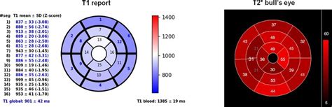 Representative Myocardial Native T1 And T2 Reports For A Patient With