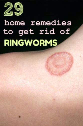 29 Remedies To Get Rid Of Ringworm Quickly — Info You Should Know