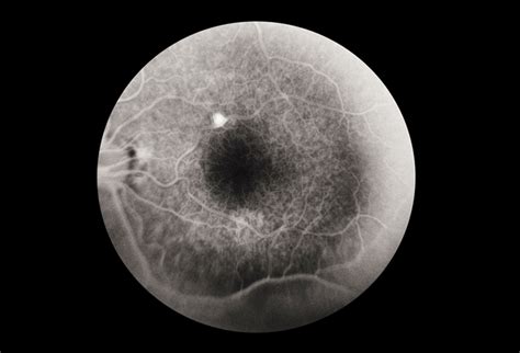 Armd Rpe Defect Myelinated Nfl Retina Image Bank