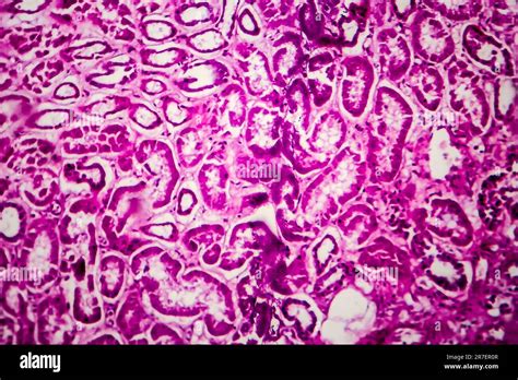 Glomerulonephritis Light Micrograph Of Tissue From A Kidney In A Case
