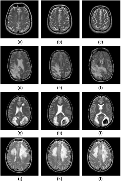 PDF MRI Brain Classification Using Texture Features Fuzzy Weighting