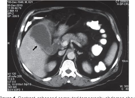 Figure 1 From Spontaneous Perforation Of Gallbladder With Intrahepatic Bilioma Semantic Scholar