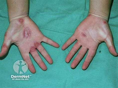 Erythema Multiforme Images