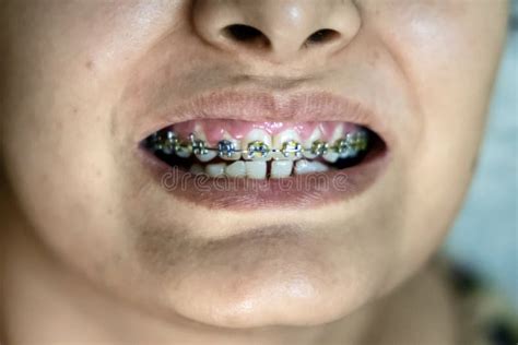 Young Girl Showing Her Teeth Bracing To Dentist From Different Angle