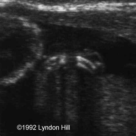 📃 Diastrophic Dysplasia