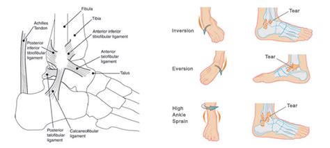 Chronic Lateral Ankle Pain Chicago Foot Care Clinic
