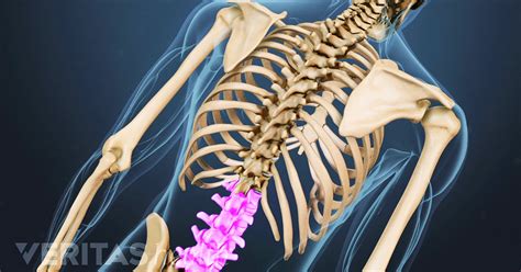 Transforaminal Lumbar Interbody Fusion Tlif Back Surgery