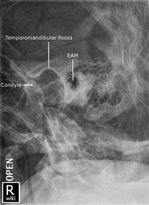 Tmj X Ray