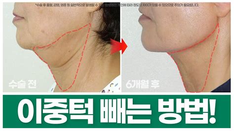 이중턱 지방은 얼굴형에 따라 빼는 방법이 다르다🤔🤔 [ 이중턱 근육묶기 이중턱 지방흡입 ] Youtube