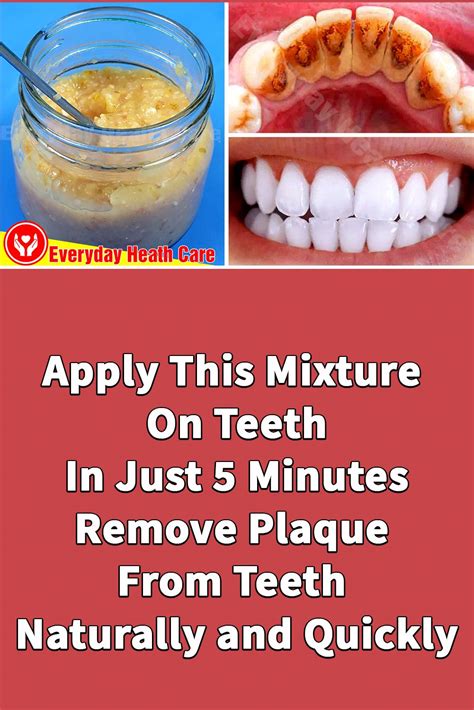 How To Remove Dental Plaque Naturally