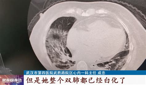 重症白肺死亡率40 出现哪些症状可能是白肺呼吸有1个变化就要小心了 患者 肺部 人群